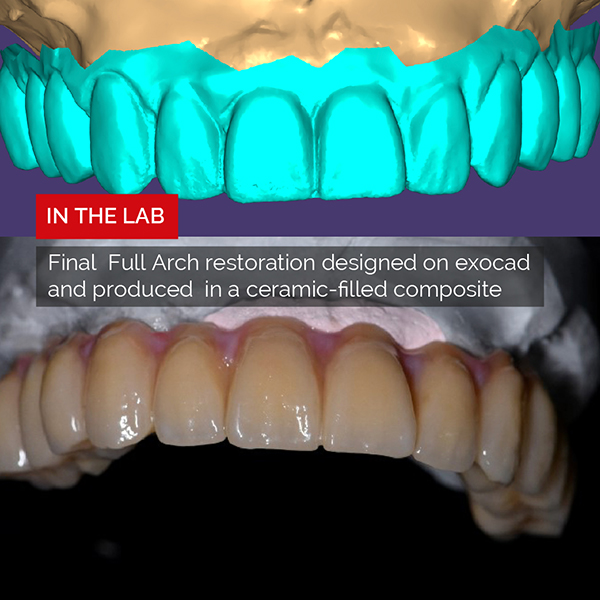 matrix® removable Full-Arch Restoration with 4 Zirconia Telescopes screw-retained directly on ...